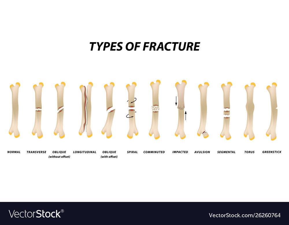 Types Fracture Fracture Bone Set Infographics Vector Image