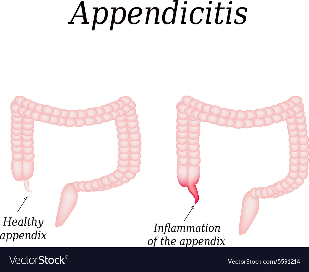 Appendicitis inflammation of the appendix colon Vector Image