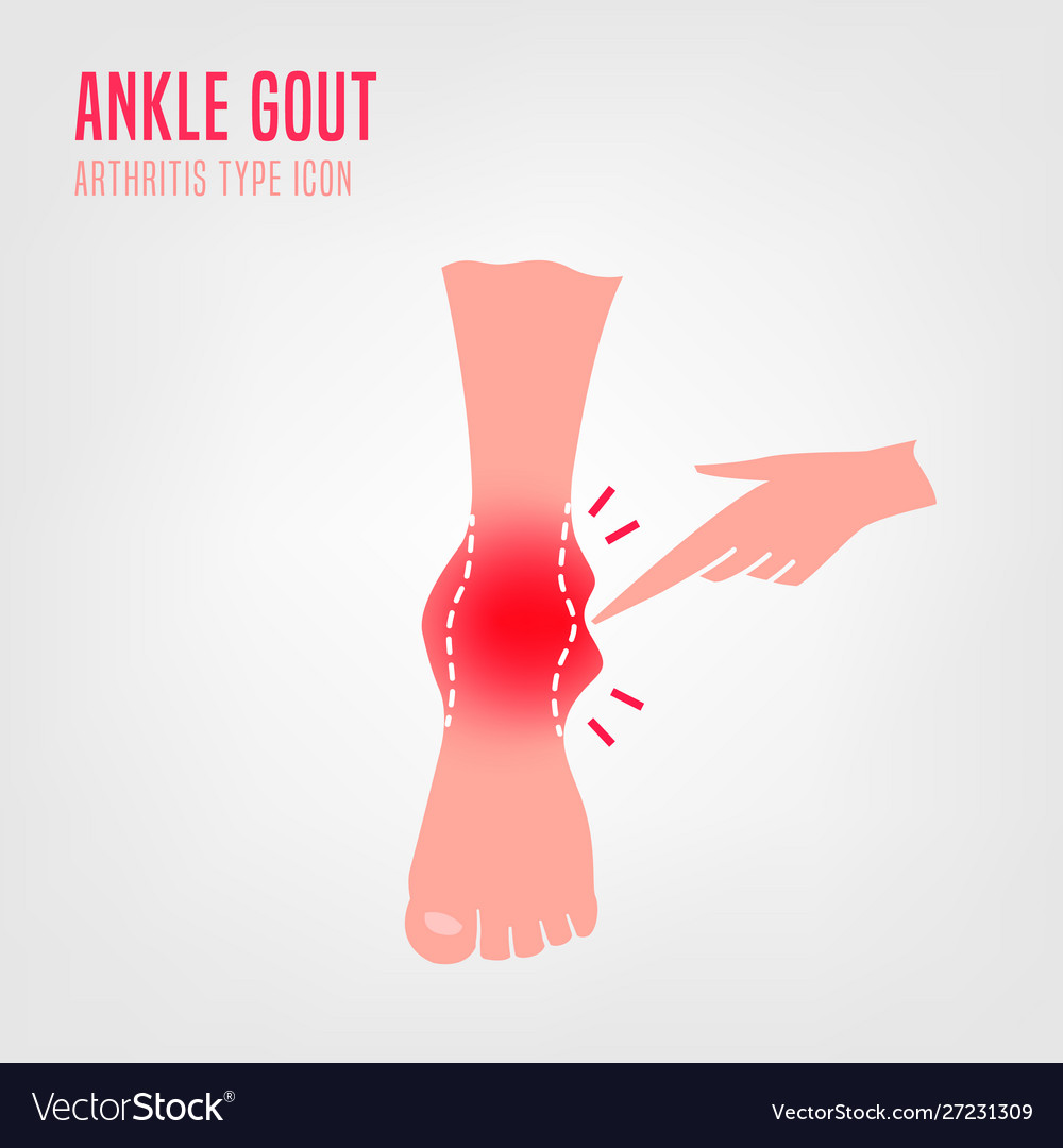 Gout arthritis icon Royalty Free Vector Image - VectorStock