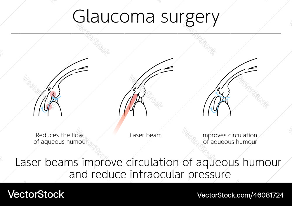 Glaucoma surgery medical Royalty Free Vector Image