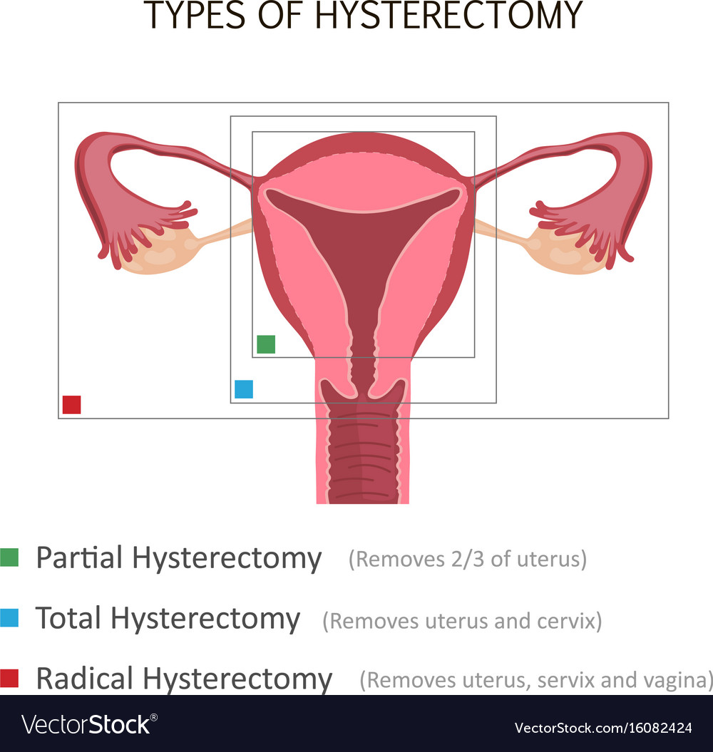 Types Of Hysterectomy Royalty Free Vector Image