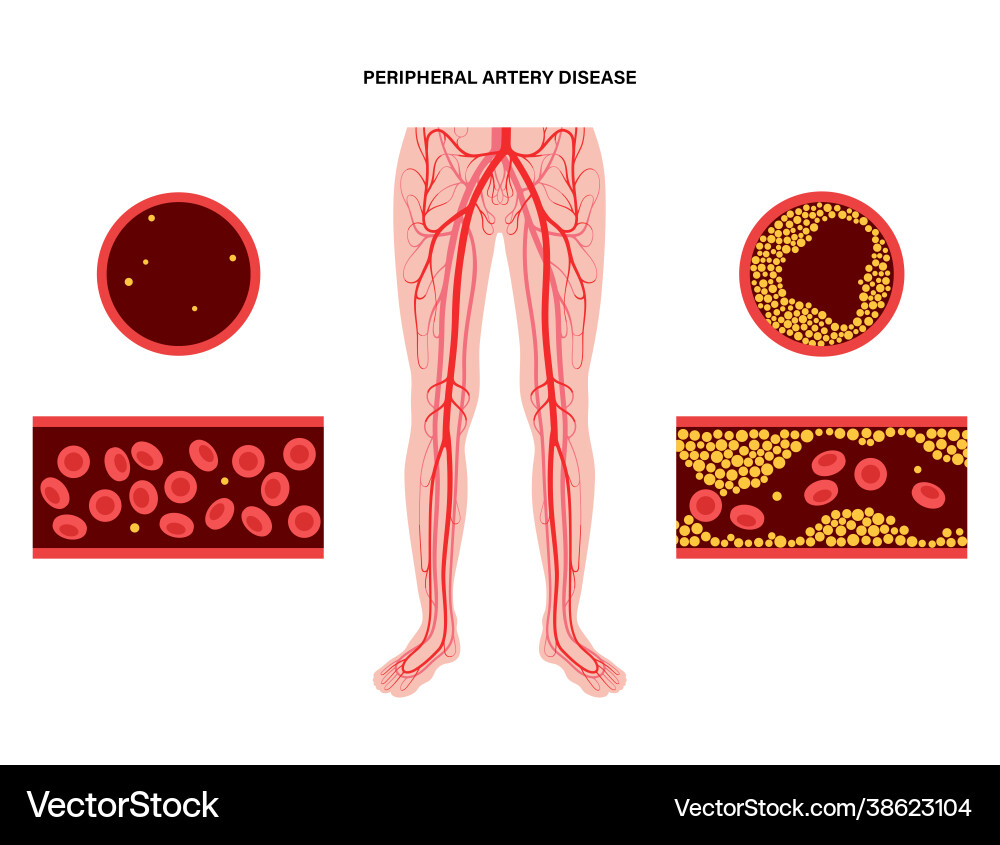 Peripheral artery disease Royalty Free Vector Image