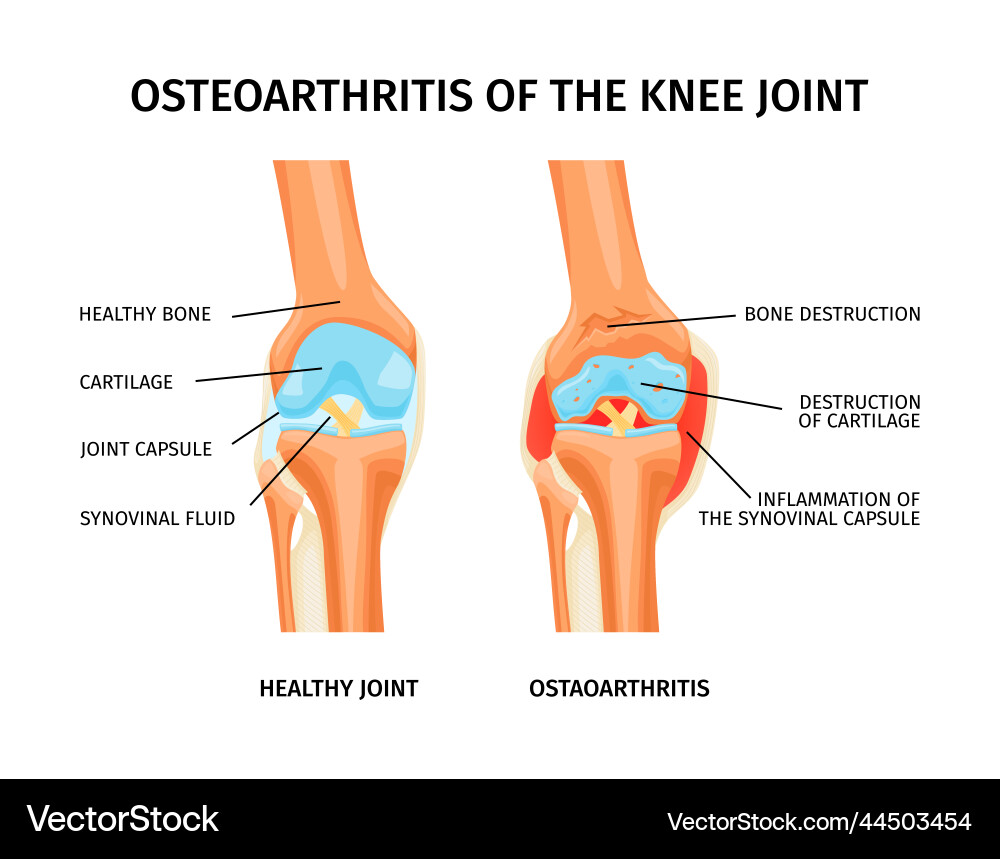 Knee joint ostheoarthritis infographics Royalty Free Vector