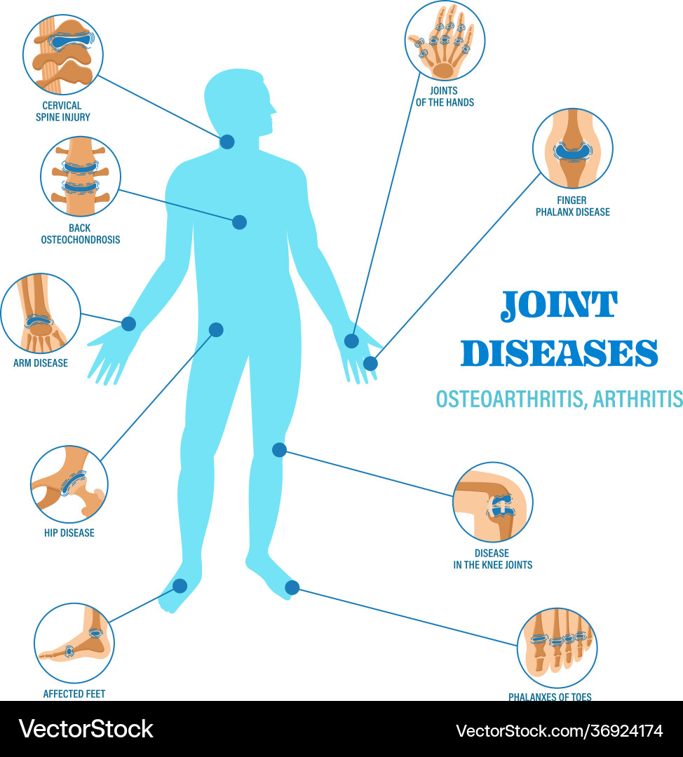 Joints diseases infographic banner infographic Vector Image