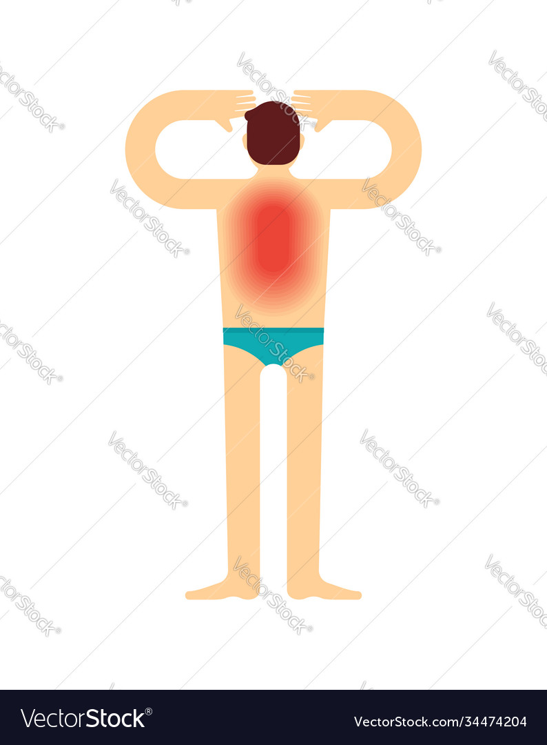 Sunburned Male Back Burned Guy Back In Sun Vector Image