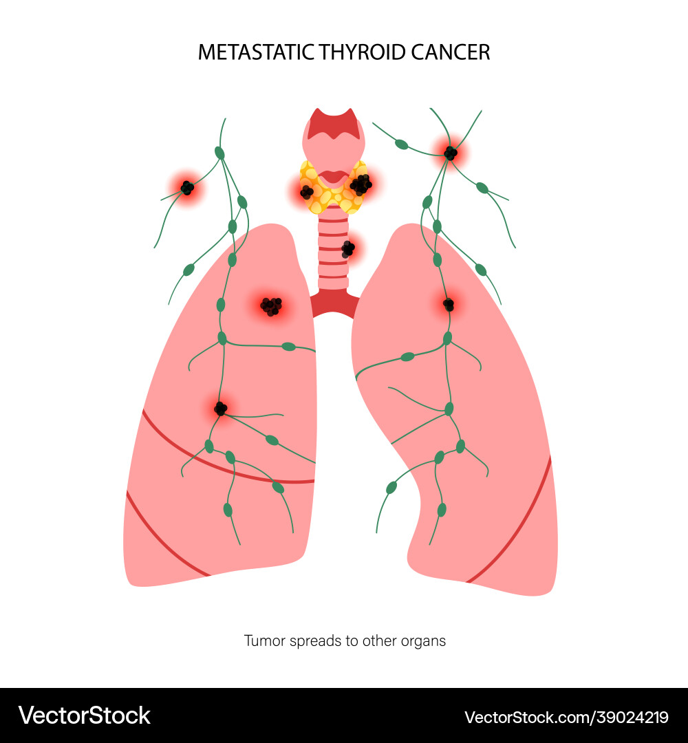 Thyroid cancer stages Royalty Free Vector Image