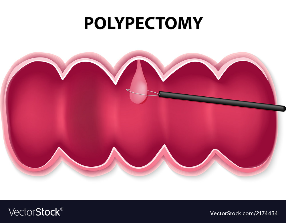Polypectomy Royalty Free Vector Image - VectorStock