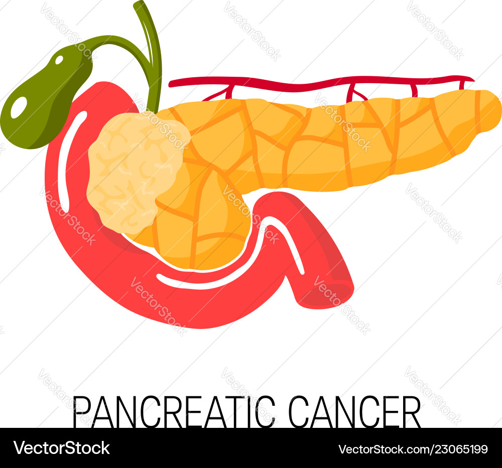 Pancreatic cancer concept Royalty Free Vector Image