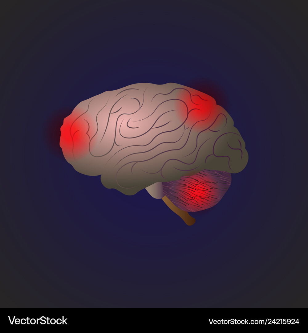Realistic medical diseases brain Royalty Free Vector Image