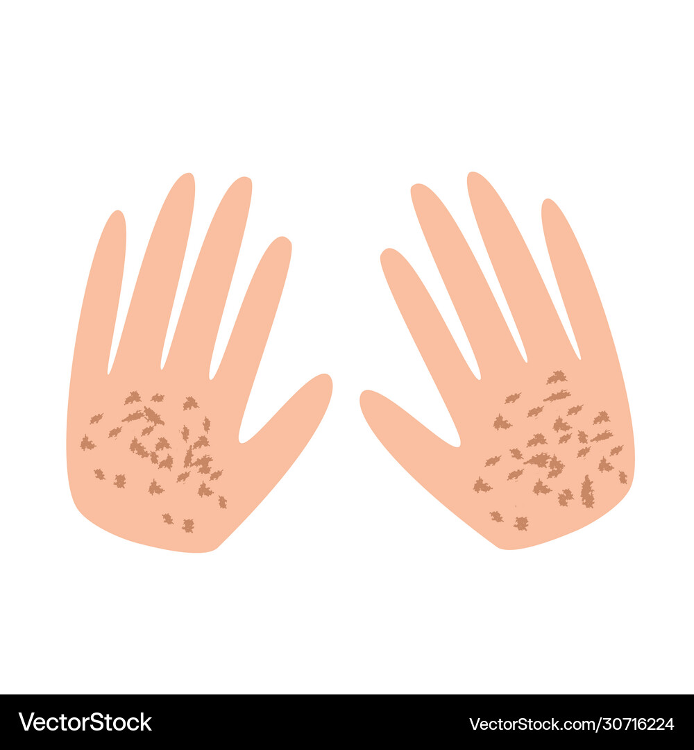 Freckles on hands pigmentation skin Royalty Free Vector