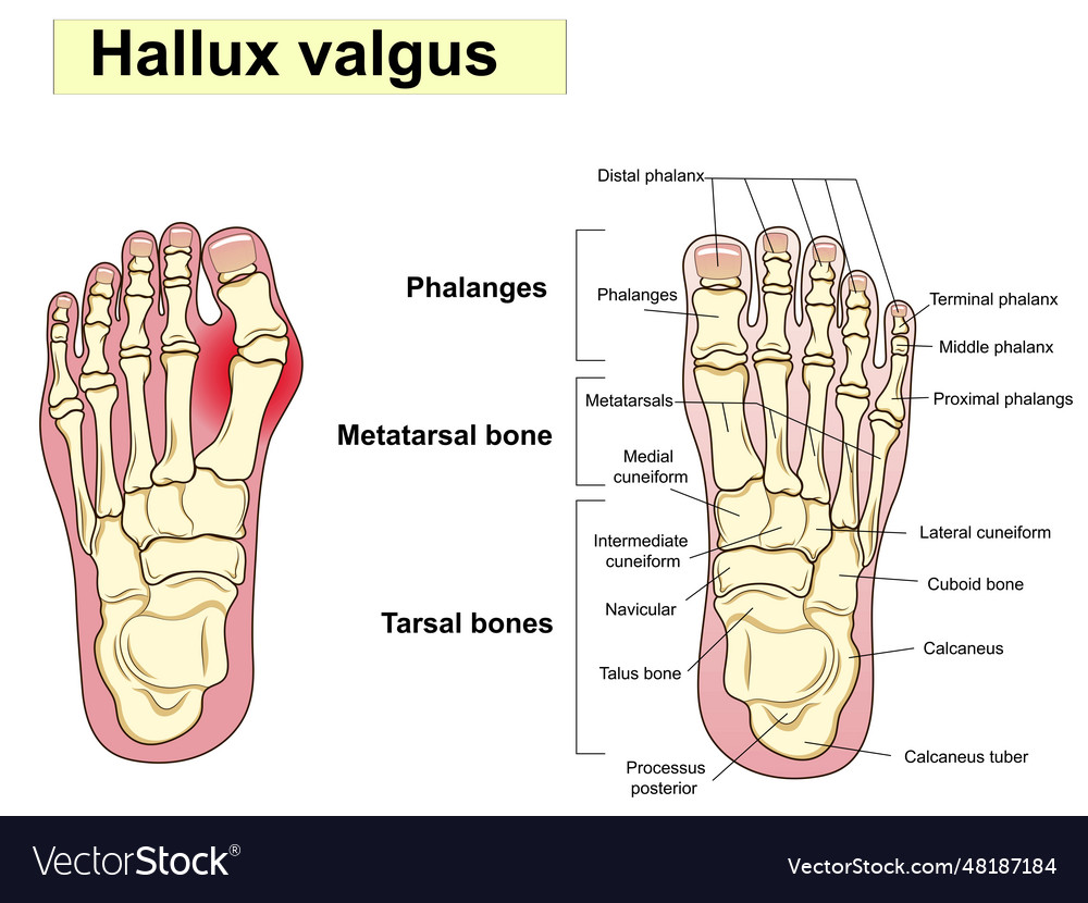 Hallux Valgus Text Anatomy Human Foot Bones Vector Image