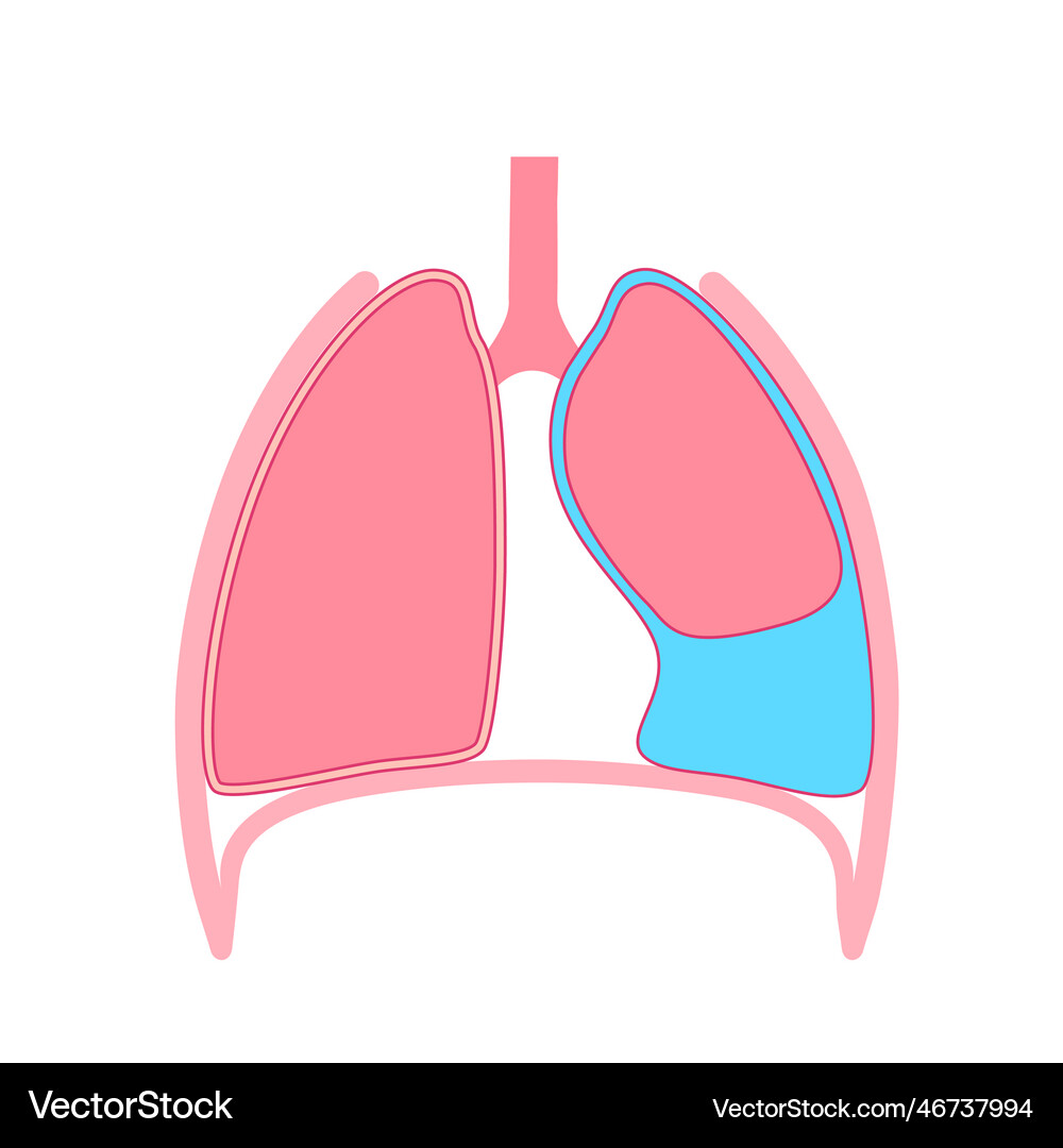 Pleural Effusion Anatomy Royalty Free Vector Image