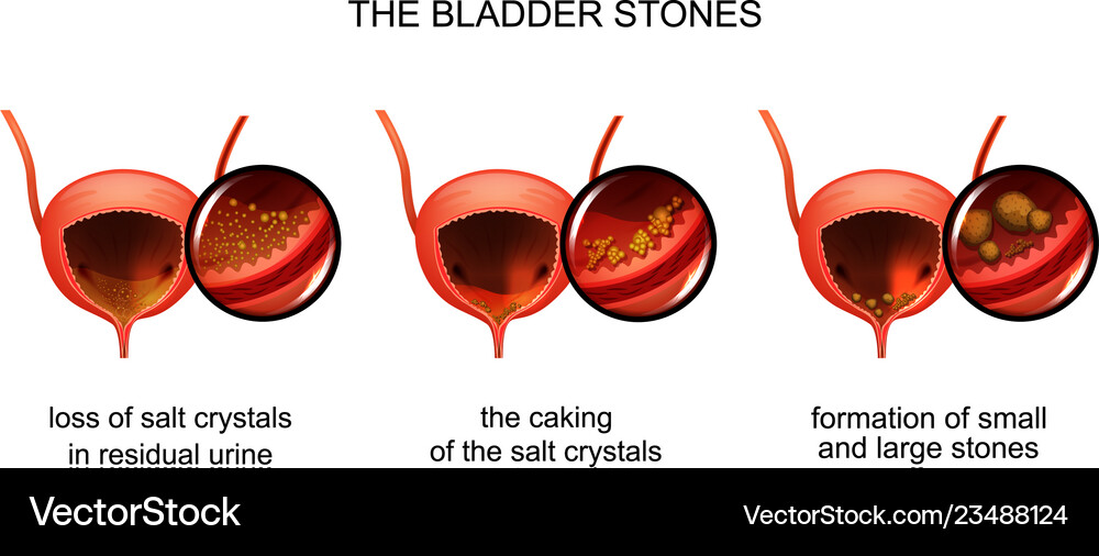 Formation of bladder stones Royalty Free Vector Image