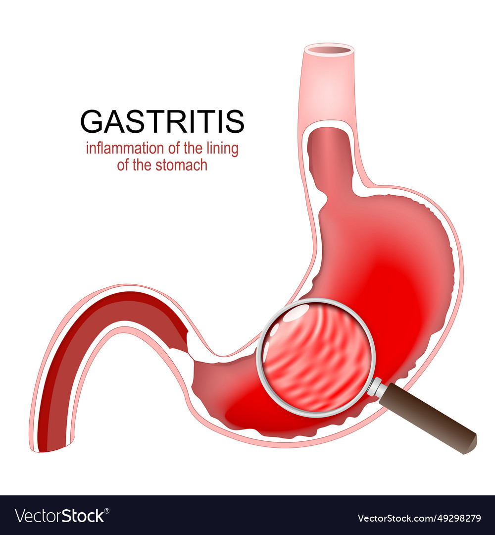 Gastritis Stomach Inflammation Royalty Free Vector Image