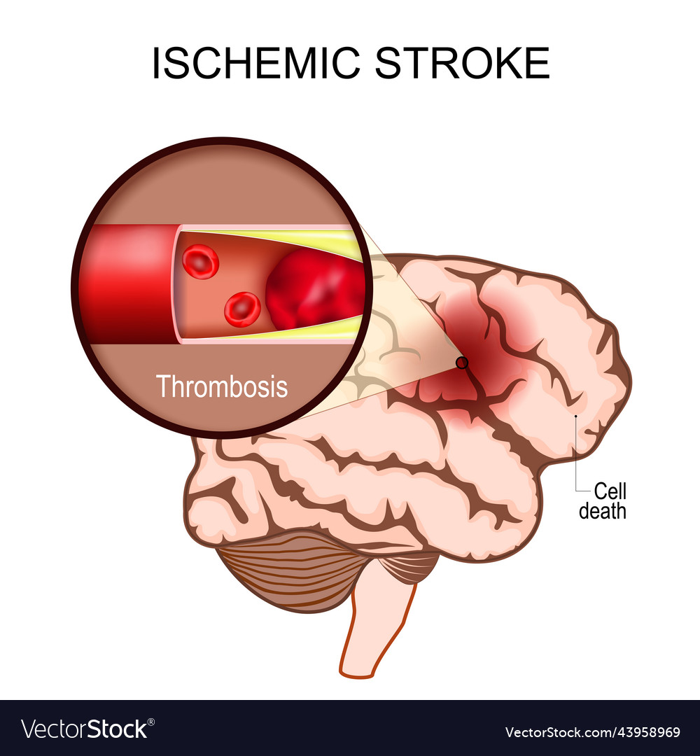 Ischemic Stroke Human Brain Royalty Free Vector Image