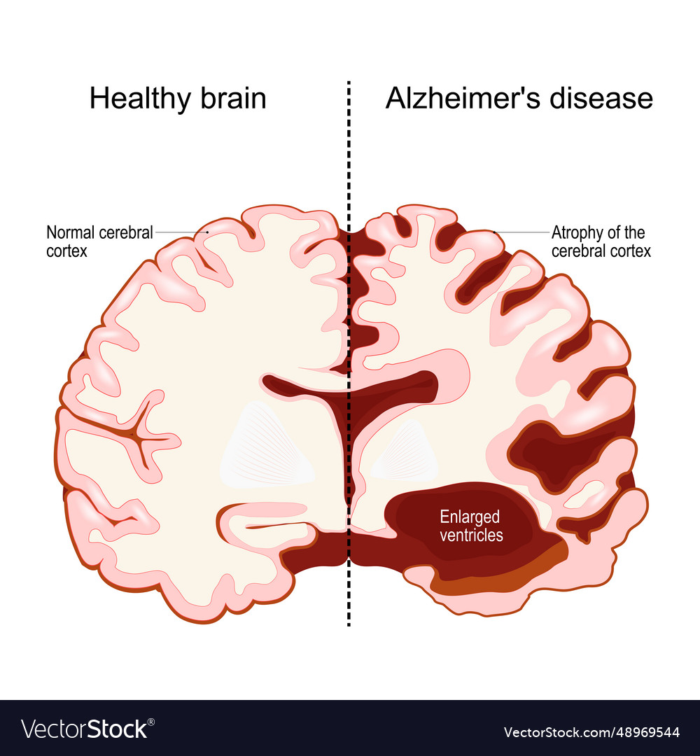 Alzheimer's Brain - Healthy vs. Disease Royalty Free Vector