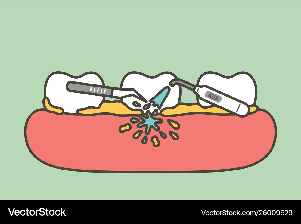 Teeth scaling - dental plaque removal for cleaning