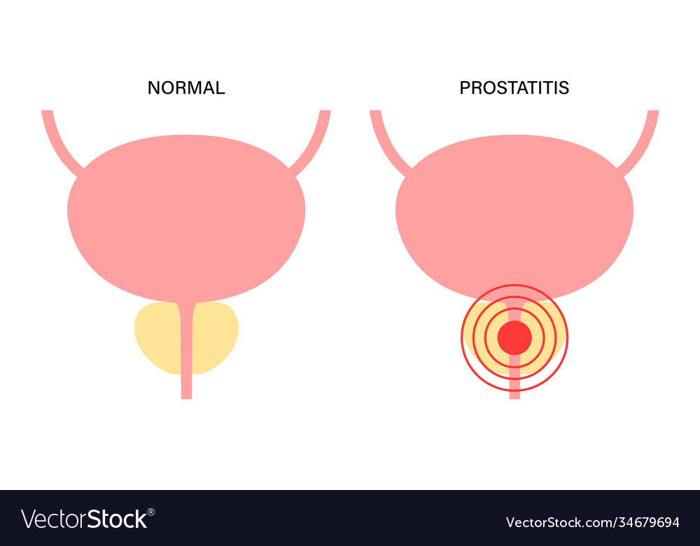 Prostatitis inflammation problem Royalty Free Vector Image