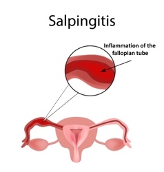 Salpingitis Inflammation of the fallopian tube Vector Image