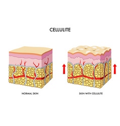 Cellulite Royalty Free Vector Image - VectorStock