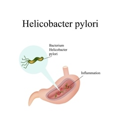 Helicobacter pylori symptoms of infection Vector Image