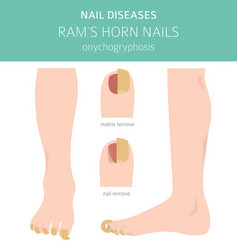 Nail diseases onychocryptocosis ingrown toenail Vector Image