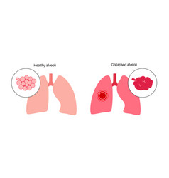Emphysema anatomical poster Royalty Free Vector Image
