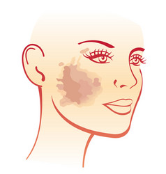 Melasma Royalty Free Vector Image - VectorStock