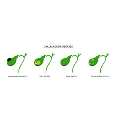 Gallbladder diseases poster Royalty Free Vector Image